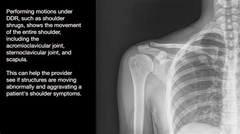 Sternoclavicular Joint Sprain