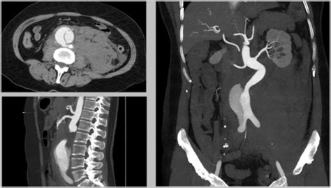 Acute Symptomatic Isolated Abdominal Aortic Dissection Clinical