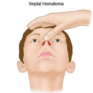 Nasal Fracture What You Need To Know