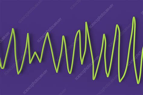 Torsades De Pointes Heartbeat Rhythm Illustration Stock Image F038