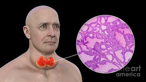 Enlarged Thyroid Gland And Protruding Eyes 11 Photograph By Kateryna
