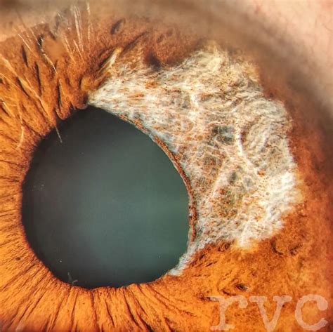 Patchy Iris Atrophy In Ophthalmology Notes And Synopses Facebook