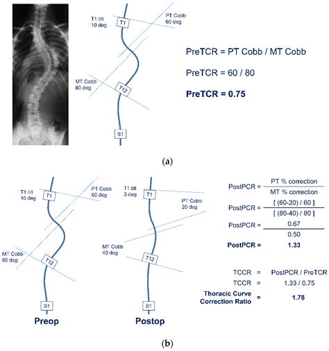 Thoracic Curve Correction Ratio An Objective Measure To Guide Against Overcorrection Of A Main