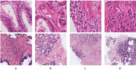 논문 리뷰 Classification Of Gleason Grading In Prostate Cancer