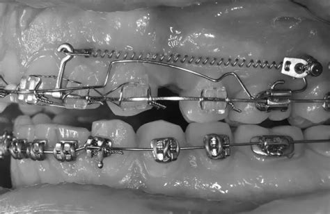 Mini Implants Tads Iqdent