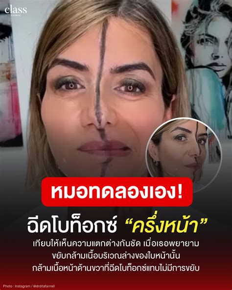 โปรโมชั่น Class Clinic Classclinic