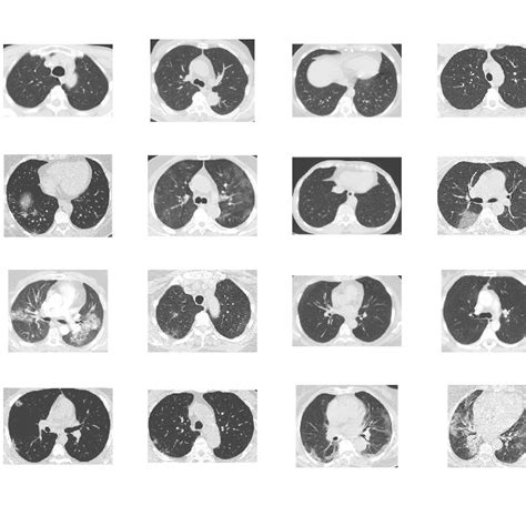 PDF SARS CoV CT Scan Dataset A Large Dataset Of Real Patients CT Scans For SARS CoV