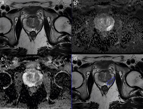 Deep Learning Network Shows Significant Potential For Prostate Cancer Detection On Mri
