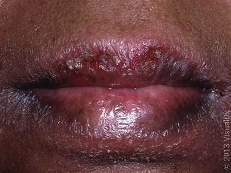 Why Are My Lips So Dry 10 Causes Of Chapped Lips And Remedies Goodrx