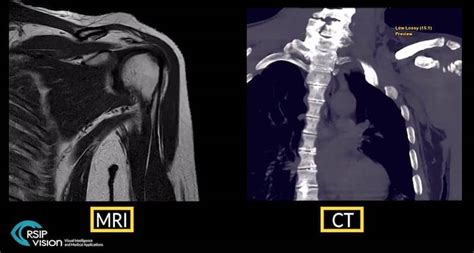 Rsip Vision Presents New Tool For Total Shoulder Arthroplasty Planning Through Mri Scan Axis