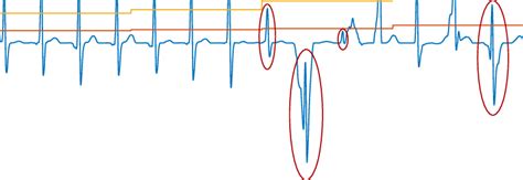 Missed Peaks In Ellipses In Reward R Peak Detection Using Hysteresis Download Scientific