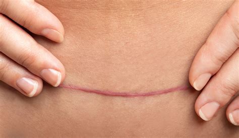 Hypertrophic Vs Keloid Scars What You Need To Know Epi Dermatology And Laser Specialist Clinic