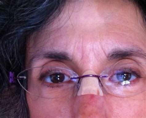 Outtakes Living With Scleroderma