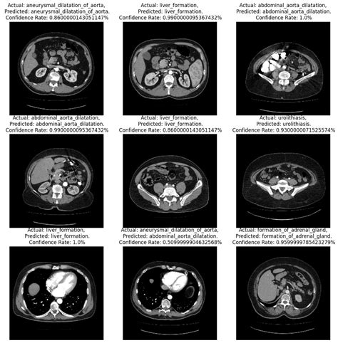 Ravikant Singh On Linkedin Deeplearning Computervision Abdominalabnormalities Ai