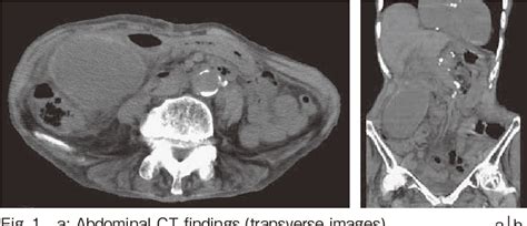 Figure 1 From A Case Of Gallbladder Volvulus Diagnosed Preoperatively