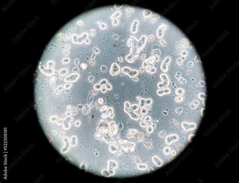 Human Breast Cancer Cells Cultured In Vitro Microscopic Phase Contrast Image Cancer Cells Are