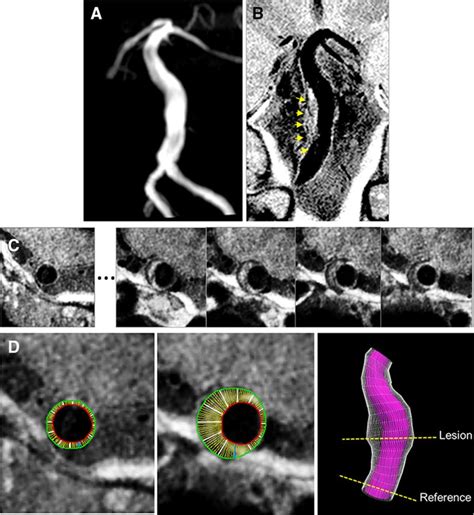 Patterns And Implications Of Intracranial Arterial Remodeling In Stroke