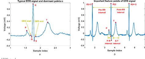 Figure 3 From Deep Neural Network Based Approach For Ecg Classification