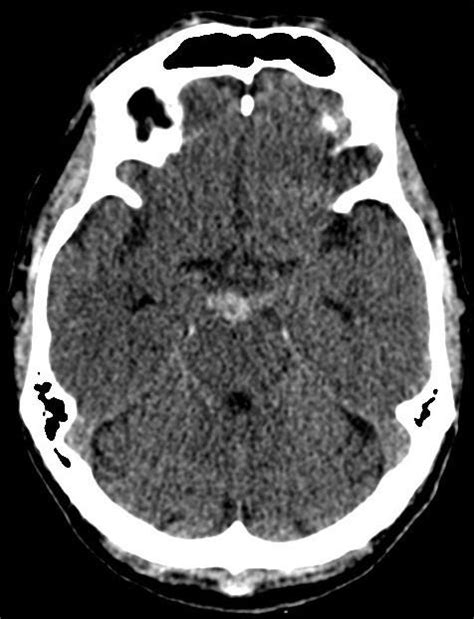 Nonaneurysmal Perimesencephalic Subarachnoid Haemorrhage Eurorad