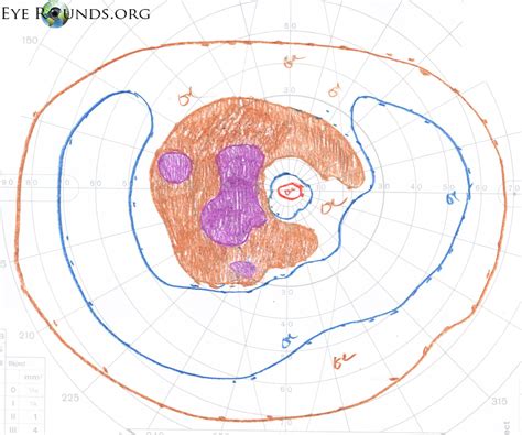 Atlas Entry Retinitis Pigmentosa Sine Pigmento
