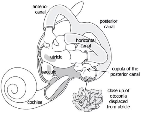 Benign Paroxysmal Positional Vertigo Bppv Vestibular Disorders