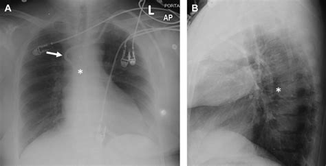 Imaging Approach To Misplaced Central Venous Catheters Radiology Key