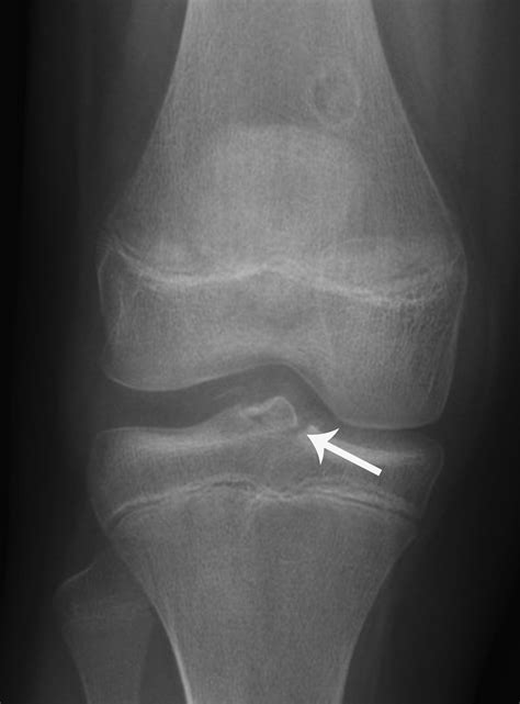 Knee X Rays Pictures