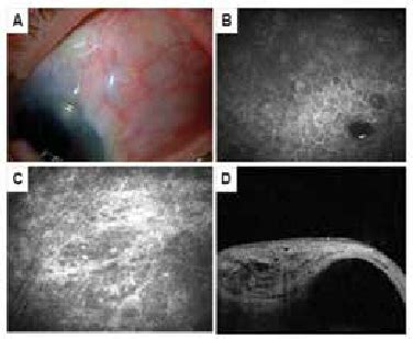 Flat Bleb A The Bleb Does Not Show Elevation In Biomicroscopic Download Scientific Diagram