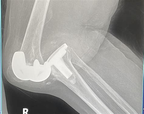 My First Dislocated Knee As An Intern R Radiology