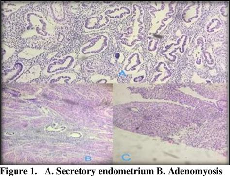 Figure 1 From Histopathology Of Endometrium In Cases Of Abnormal Uterine Bleeding Semantic Scholar