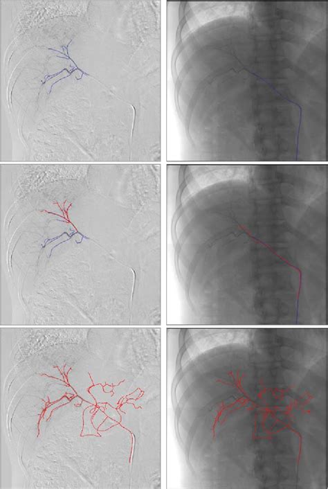 Figure 1 From Locally Adaptive 2d 3d Registration Using Vascular Structure Model For Liver