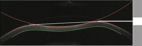 Radius Of Curvature At Highest Concavity Or Inverse Concave Radius