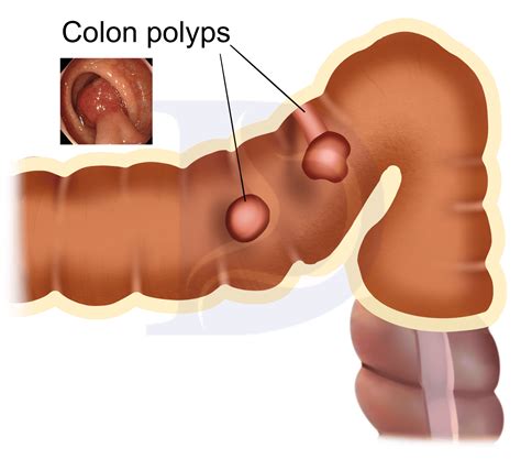 colon polyps digestive and liver health specialists