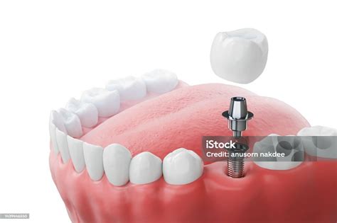 치과 이식 임플란트 나사가 있는 치아 3d 그림 치아 임플란트에 대한 스톡 사진 및 기타 이미지 치아 임플란트 임플란트 치아 건강 Istock