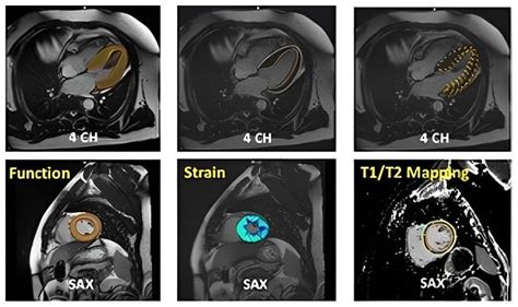 An Evaluation Of Zero Click Whole Workflow Of Cardiovascular Magnetic Resonance Cardiac Function