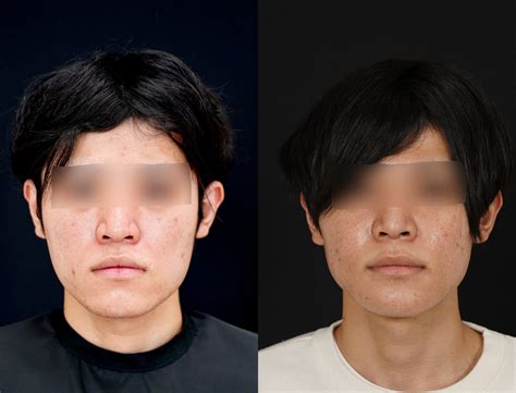 受け口輪郭の治し方Vライン形成 公式リノクリニック東銀座銀座の美容外科美容皮膚科形成外科皮膚科