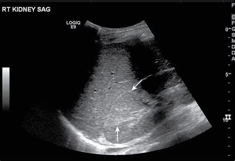 Diffuse Renal Parenchymal Disorders Radiology Key