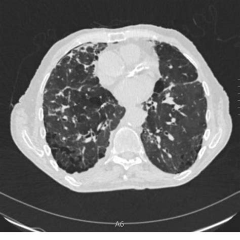 CT Thorax Showing Traction Bronchiectasis Widespread Emphysema And Download Scientific Diagram