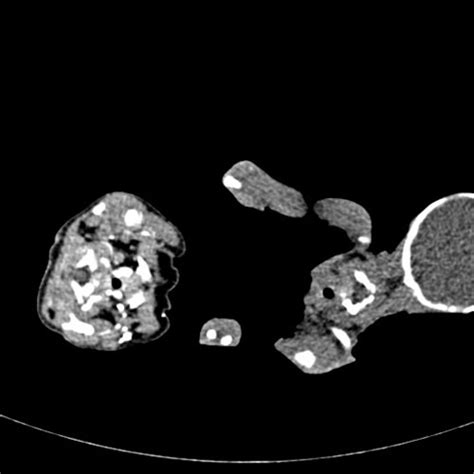 Conjoined Twins Thoracopagus Whole Body Cts