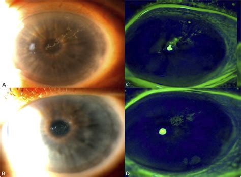 Double Trouble An Unusual Keratitis Case Of Herpes Simplex Cornea