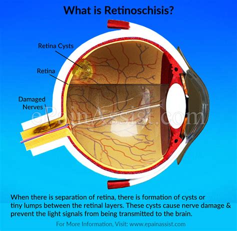 What Is Retinoschisis And How Is It Treated Types Causes Symptoms Of