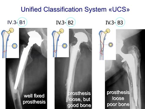 State Of The Art Fixation In Periprosthetic Fractures Revision Of