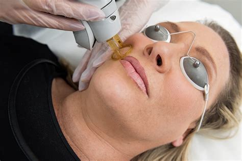 Удаление старческих пигментных пятен на лице лазером