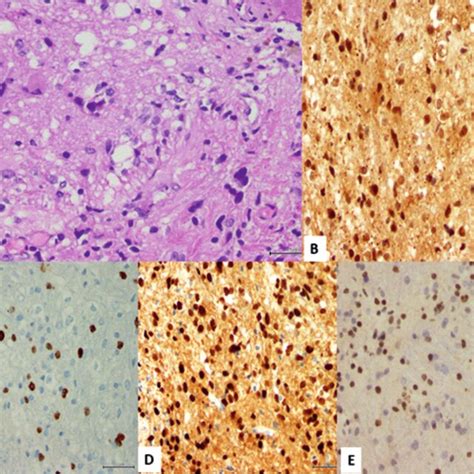 Case 6 A A Moderately Cellular Tumor With Pleomorphic Cells And