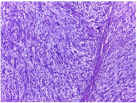 The Tumor Mass Had Myxoid Stroma Highly Pleomorphic Cells And Download Scientific Diagram