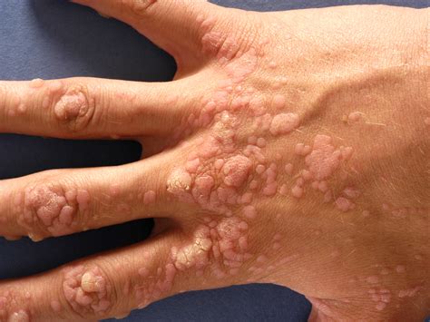 Verruca Vulgaris Warts Verruca Vulgaris Plastic Surgery Key