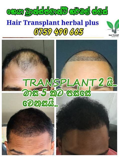 Hair 🌐 වෙනස් වෙමුද 💥 විද්‍යාතමකව රටට ගැලපෙන වෛද්‍යක්‍රමවේද දියුණු කිරිම යුගයේ අත්‍යාවශ්‍ය