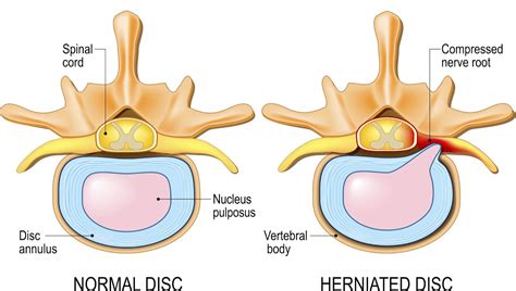 Lumbar Disc Pathology —physical Therapt Comprehensive Athletic Recovery