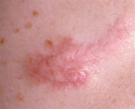 Cartilage Keloid Symptoms Keloid Scars Signs And Symptoms Dybne