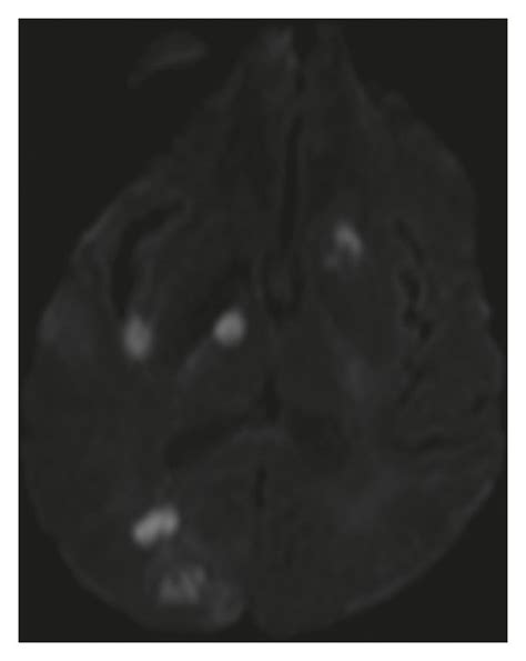 Image Of Mri Brain Showing Multifocal Areas Of Diffusion Restriction